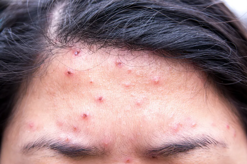 Chickenpox Scar Treatment - Cosderma Skin Clinic